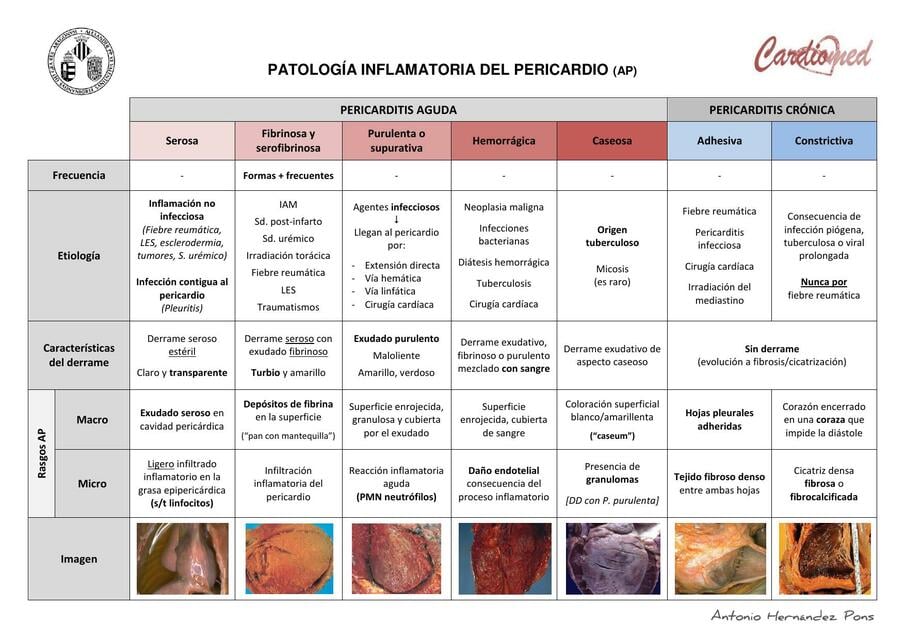 Pericarditis | Medicina Humana | uDocz