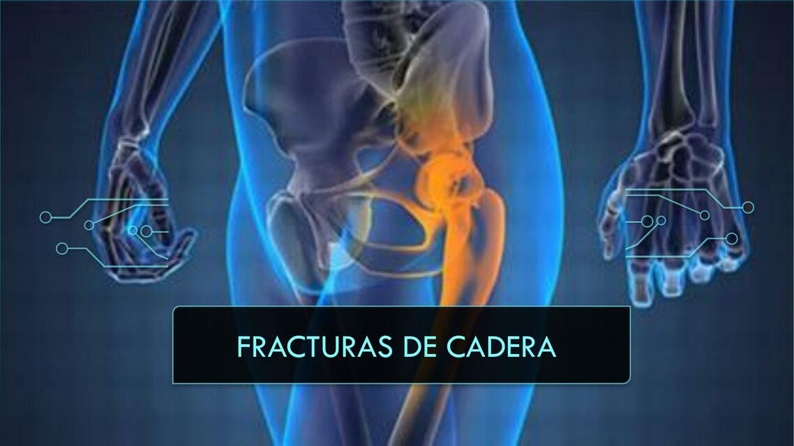 Fractura de Cadera | MERCEDES ALDAZ | uDocz
