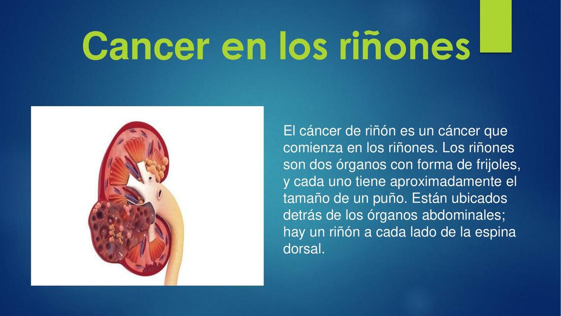 Cáncer de Riñón | Rodrigo Moreno Mendoza | uDocz