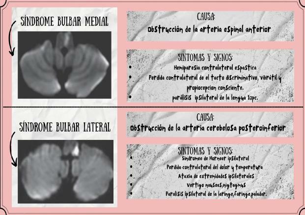Síndromes bulbares | Aixa Mercado | uDocz
