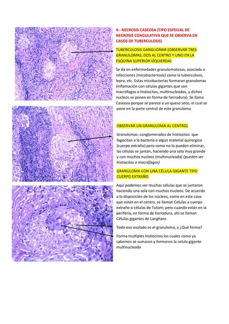 Necrosis Caseosa | Alejandro | uDocz