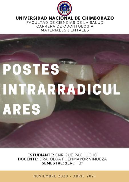 Flashcards de Postes irradiculares posterior a una endodoncia | Por ...