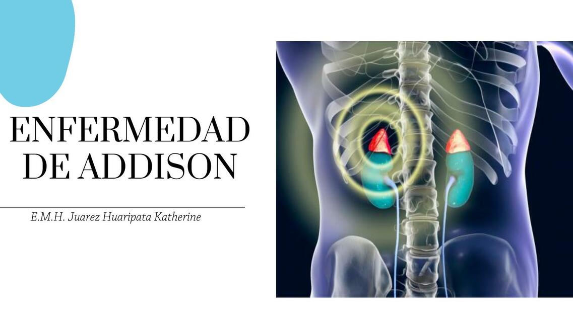 Enfermedad de Addison | JUAREZ HUARIPATA KATHERINE FIORELLA | uDocz