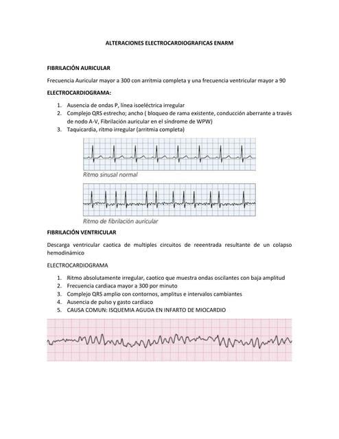 Flashcards de Electrocardiograma Enarm | Por ESPM MEDICINA | uDocz