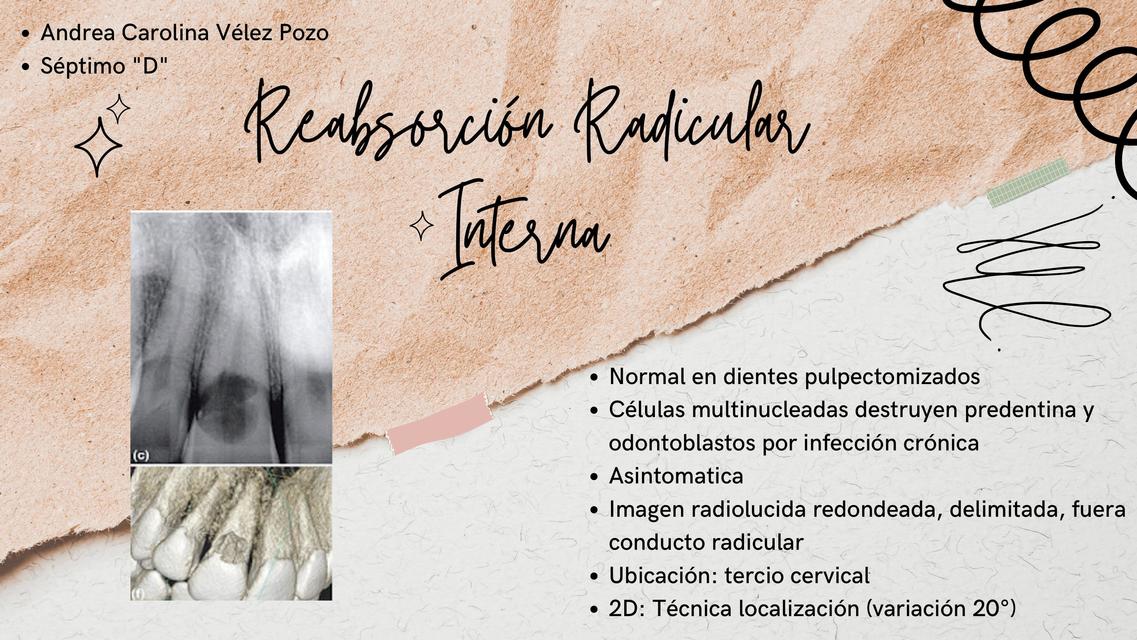 Reabsorción Radicular Interna | Dentinotes_av | uDocz