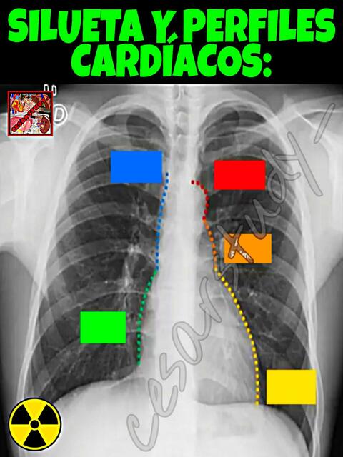 Silueta y perfiles cardíacos | Cesarstudy_ | uDocz