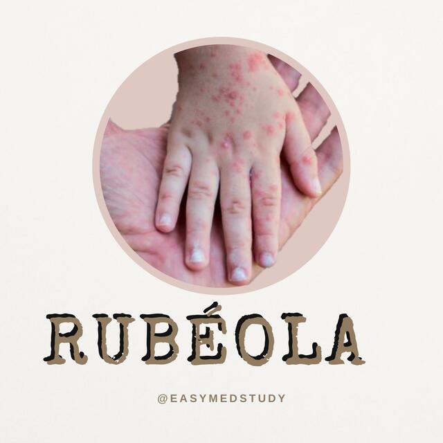 Rubeóla | Easy Med Study | uDocz