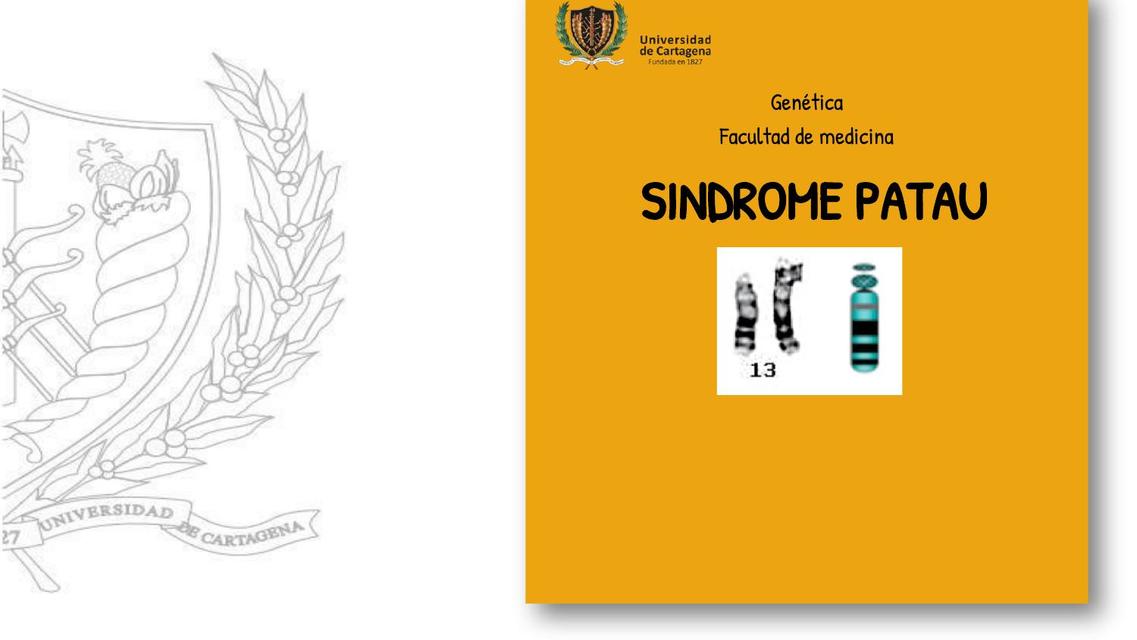 Síndrome Patau 1 o Trisomía 13