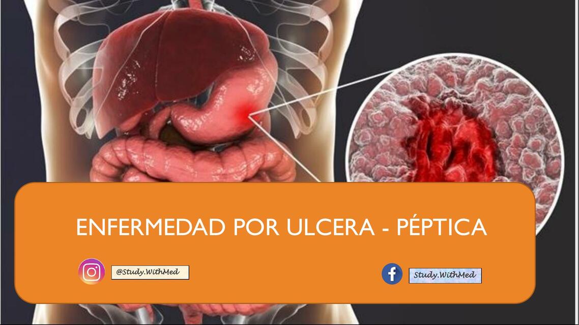 Enfermedad por úlcera péptica | StudyWithMed | uDocz