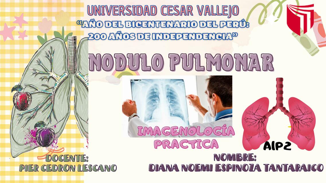 Nódulo Pulmonar | Diana Espinoza | uDocz