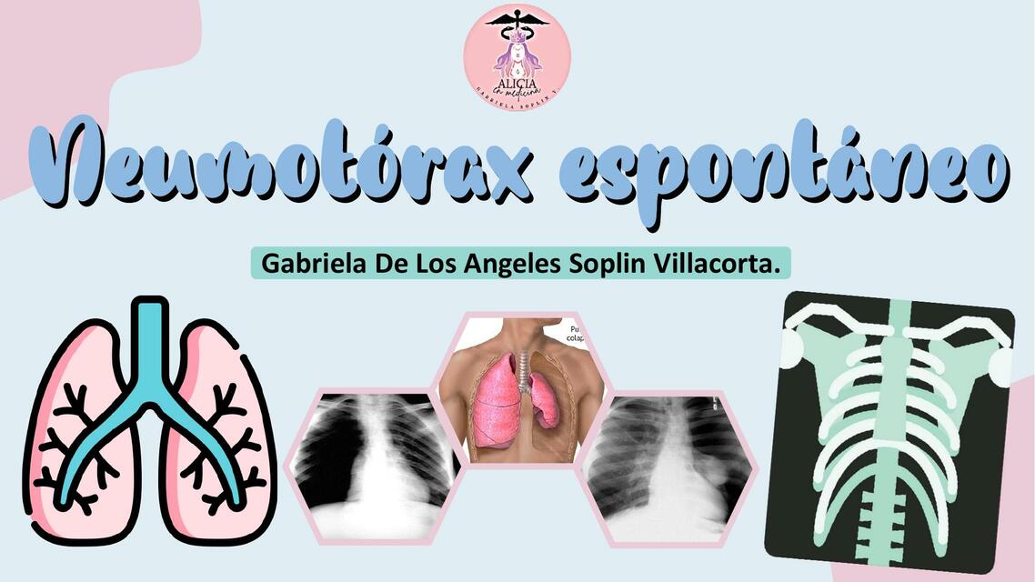 Resúmenes de Neumotórax espontáneo | Descarga apuntes de Neumotórax ...