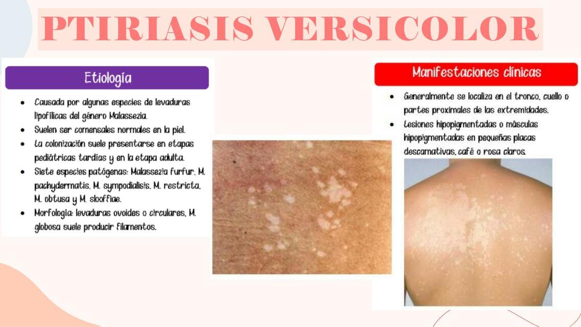 CASO CLÍNICO DE PITIRIASIS VERSICOLOR