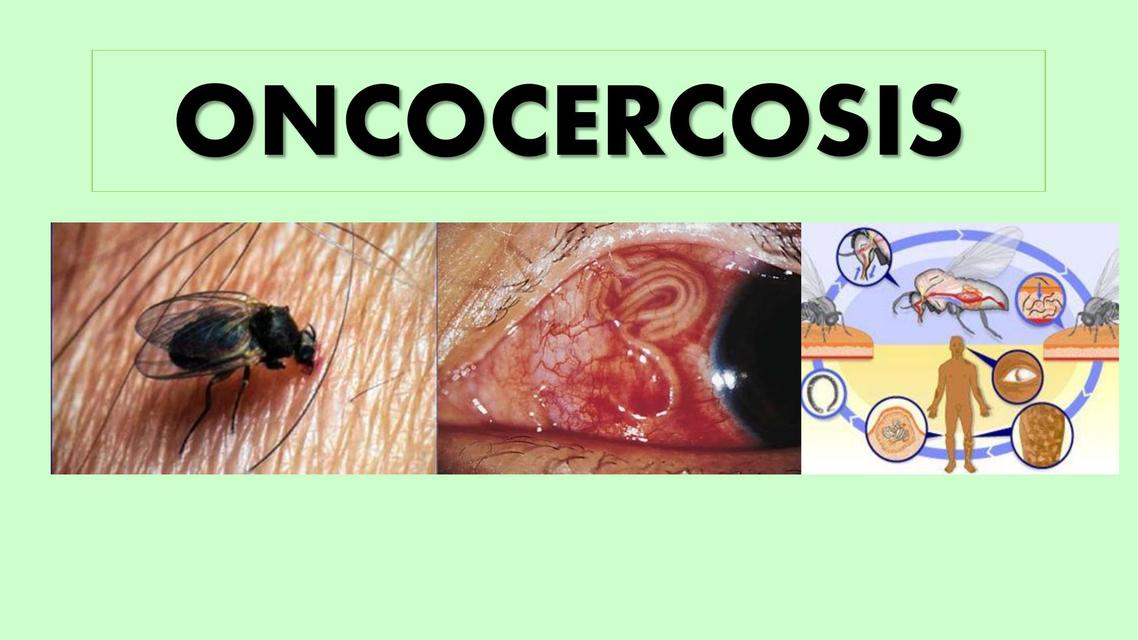 Oncocercosis | Doctor_teco | uDocz