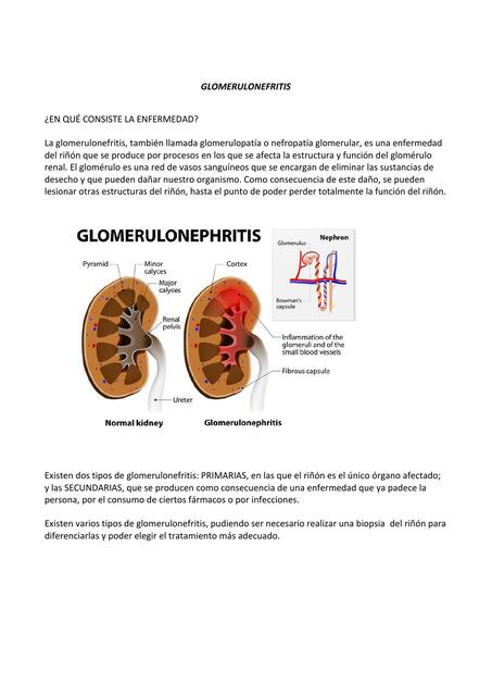 Glomerulonefritis | Hiele Disconsi | uDocz