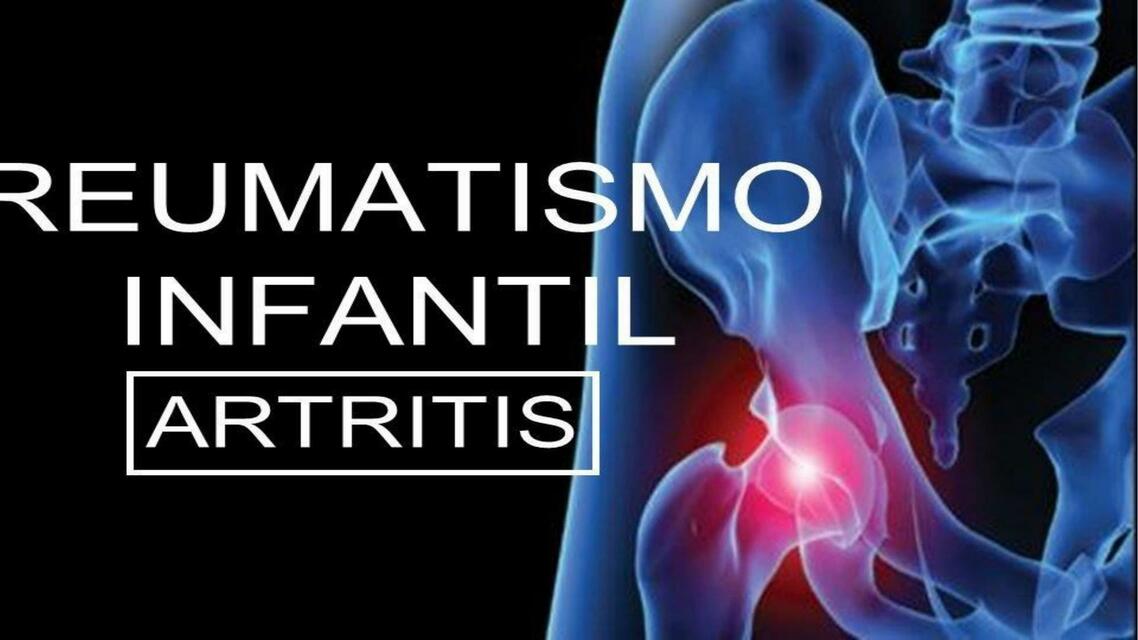 Reumatismo Infantil- Artritis | Aura Ester Peréz Rada | uDocz