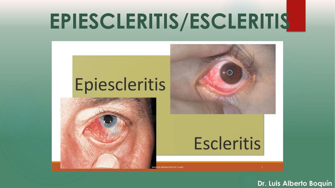 Epiescleritis Ecletitis | Todo sobre Medicina | uDocz