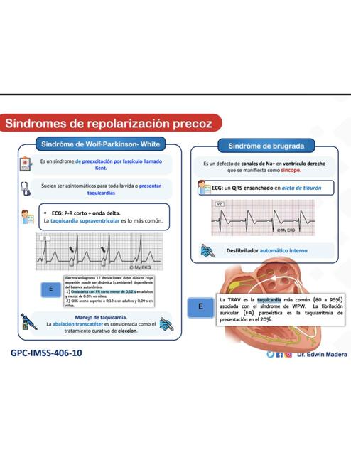 Síndromes de repolarización precoz | Maria | uDocz