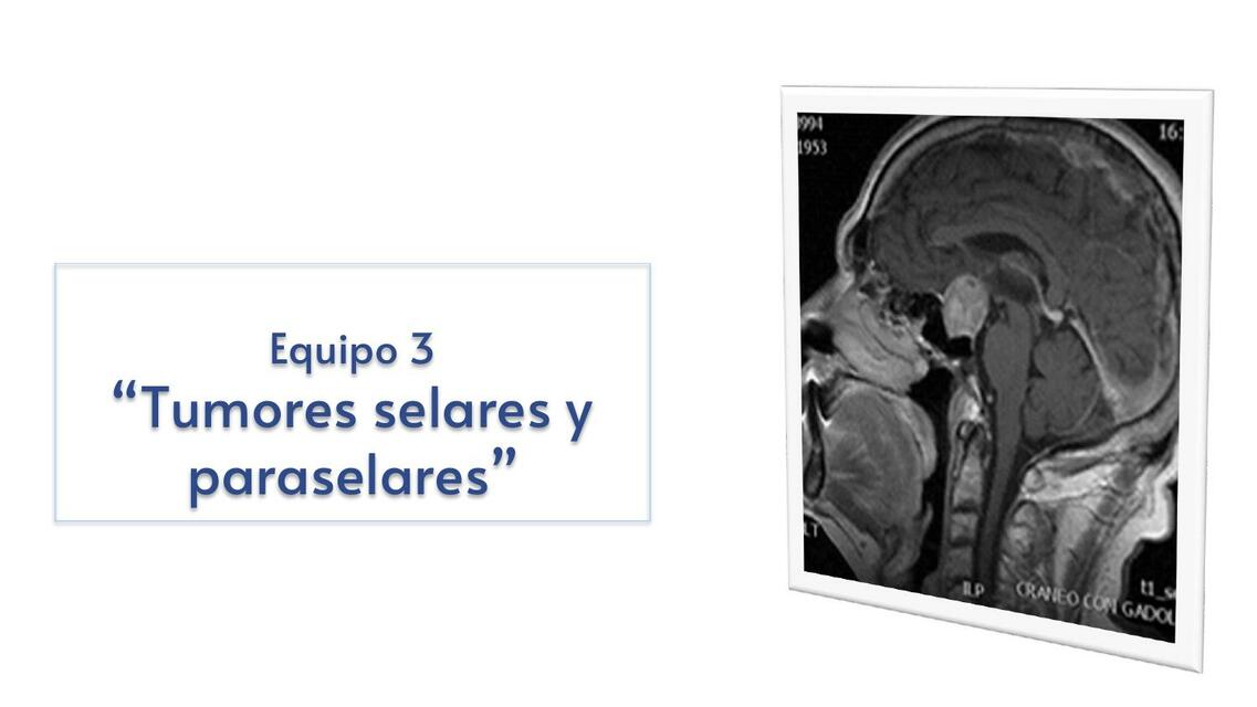 Tumores de la hipófisis | Busca y descarga apuntes gratis | uDocz