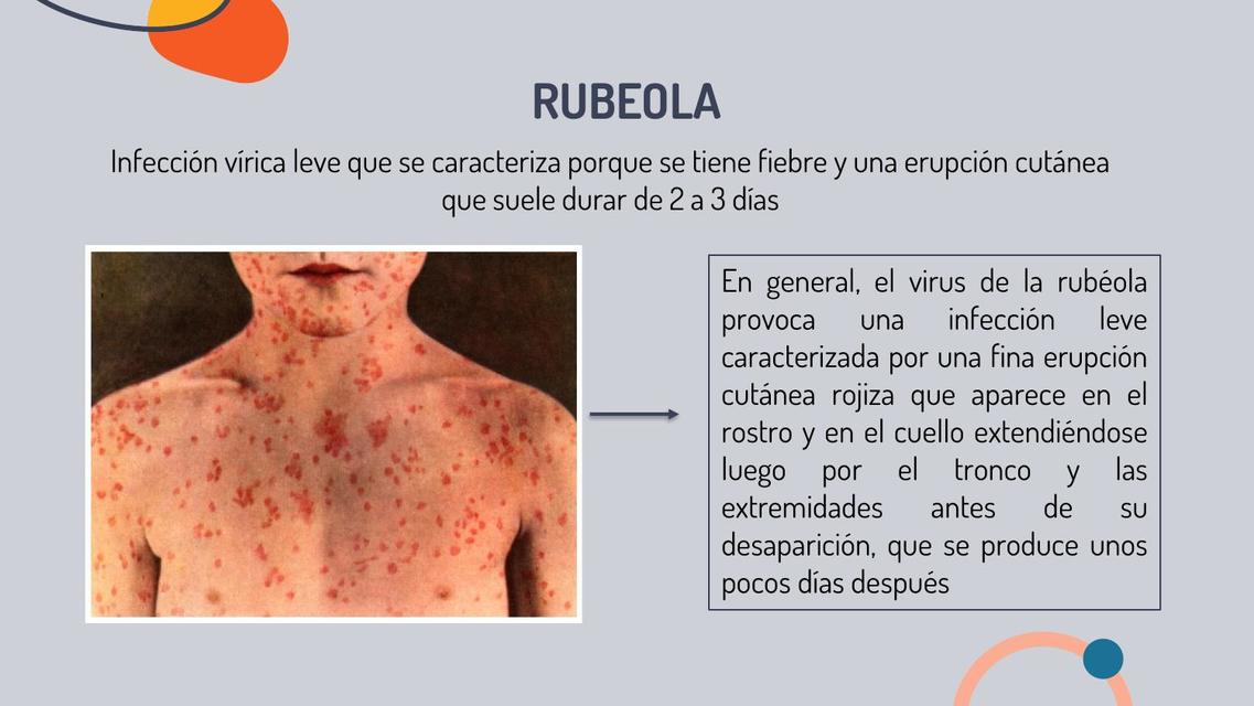 Rubeola Vs Erupcao Cutanea De Rubeola