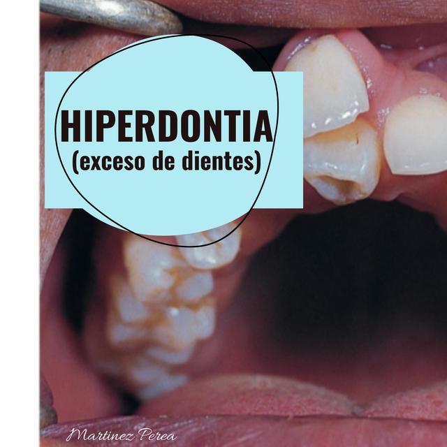 hiperdontia original | Mauro Martinez | uDocz
