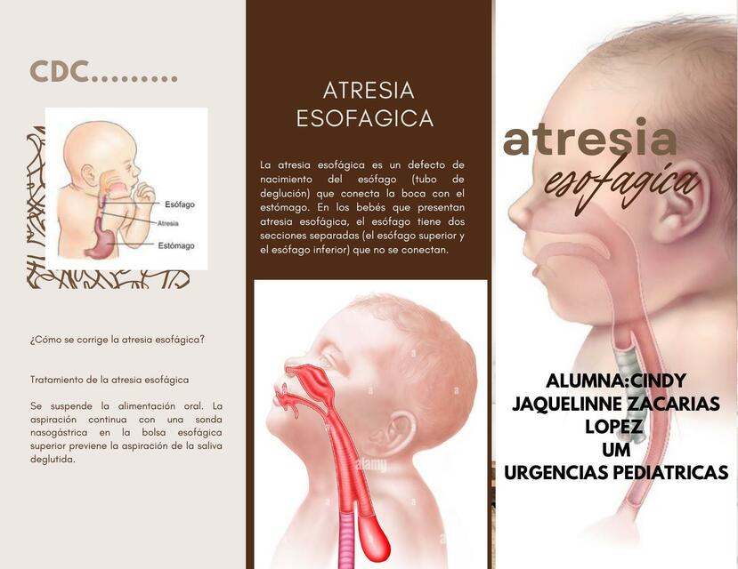 Resúmenes de Atresia esofágica | Descarga apuntes de Atresia esofágica Resúmenes de Atresia esofágica | Descarga apuntes de Atresia esofágica