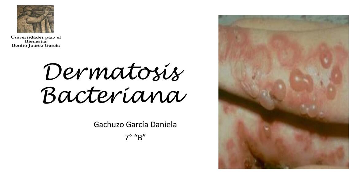 Dermatosis Bacteriana