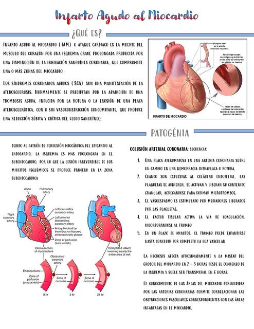 Infarto Agudo del Miocardio | Dessire Avila | uDocz
