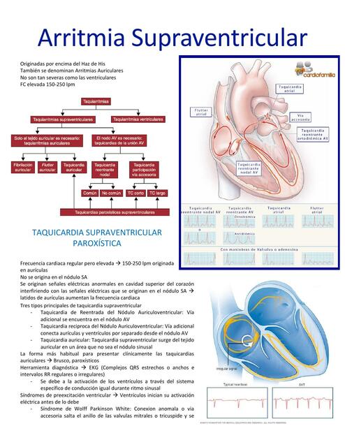Arritmia Supraventricular | Raven | uDocz