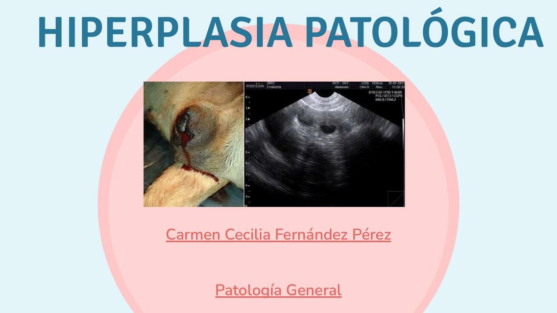 Hiperplasia patológica | Carmen Fernandez | uDocz