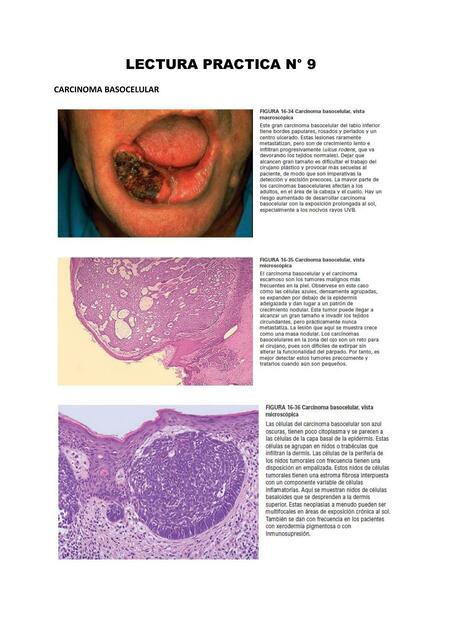 Carcinomas | Gabriela Mundaca | uDocz