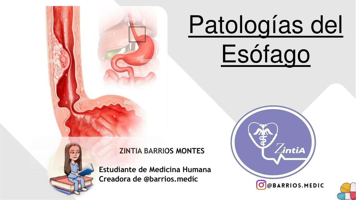 Enfermedades En El Esofago