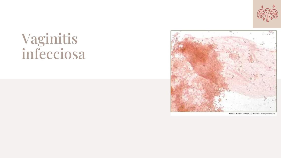 VAGINITIS INFECCIOSA 2DA PARTE | Frida Jiménez | uDocz