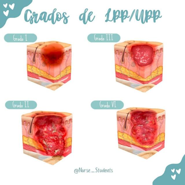 Lesiones por presión | Nurse Students | uDocz