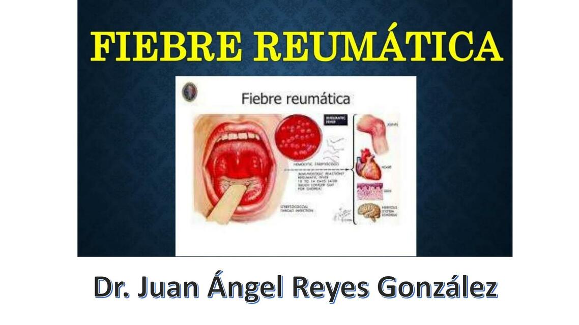 fiebre reumatica | Yissel Alejandra Salinas Chavez | uDocz