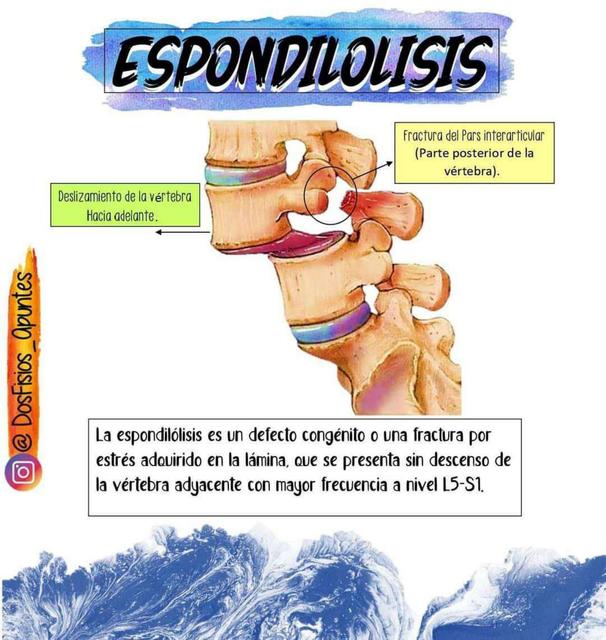 Espondilosis | YUDOC.ORG | uDocz