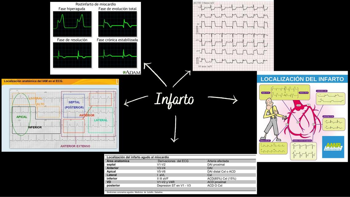 Infarto | Mario Peralta | uDocz
