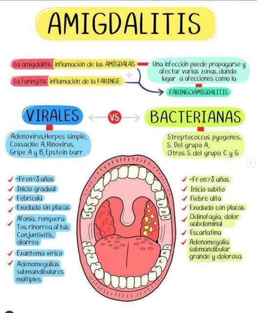 Amigdalitis | YUDOC.ORG | uDocz