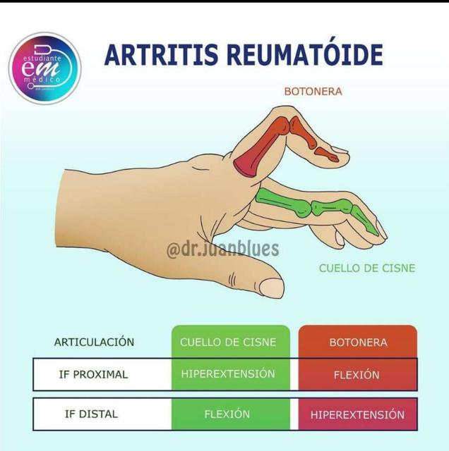 Artritis Reumatoide | YUDOC.ORG | uDocz