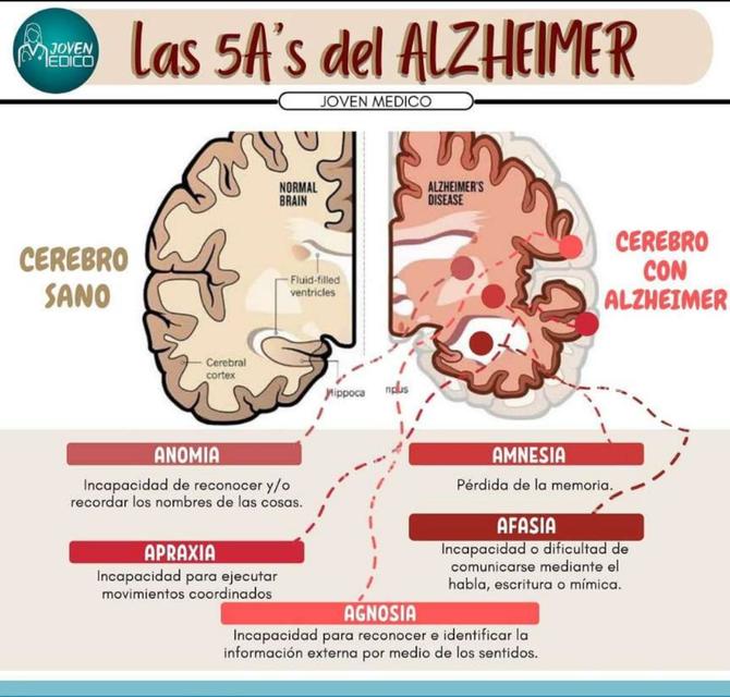 Las Cinco etapas del ALZHEIMER | YUDOC.ORG | uDocz