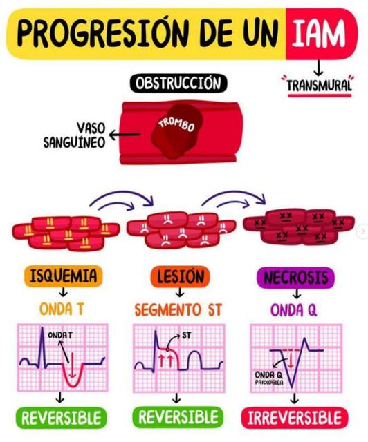 Progresión de un IAM | YUDOC.ORG | uDocz