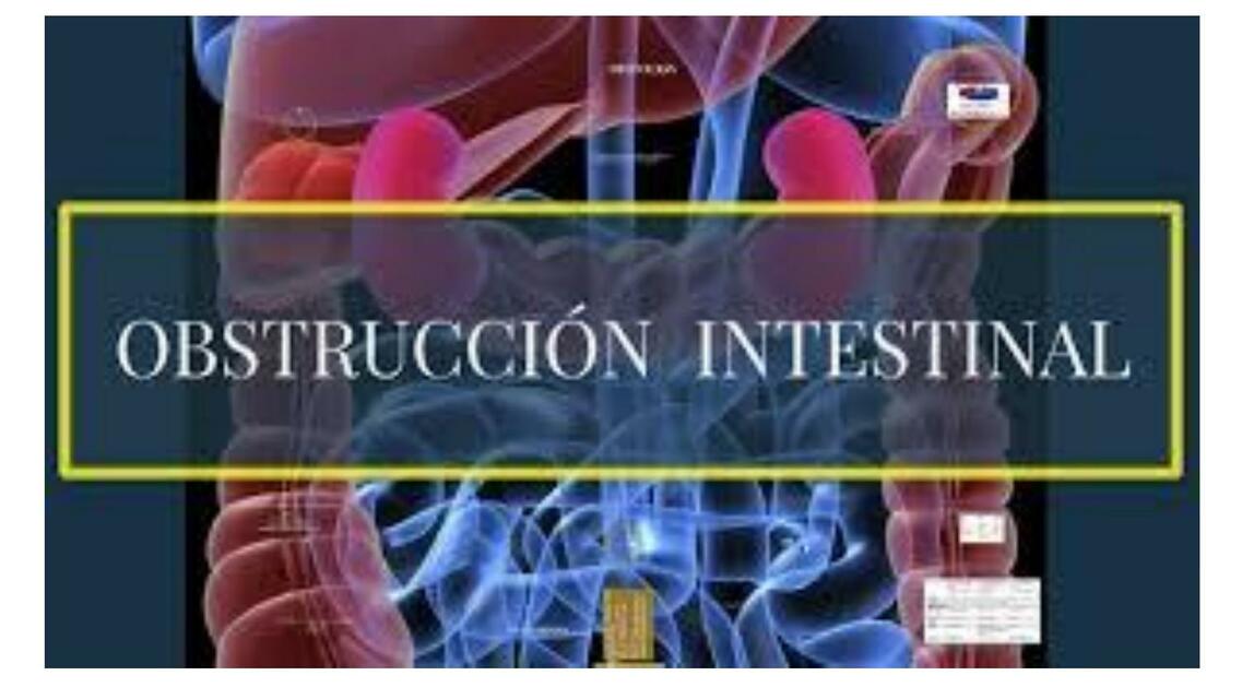 Obstrucción Intestinal | Adriana Barrientos | uDocz