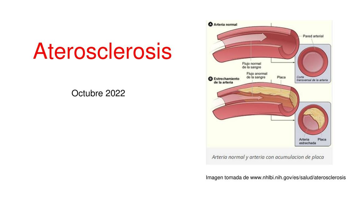 Aterosclerosis | Charles Zapata | uDocz
