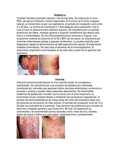 Rubeola y Varicela | Felisa Ivania Gomez Garcia | uDocz