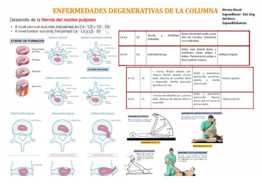 Enfermedades degenerativas de la columna | Maria Castillo | uDocz