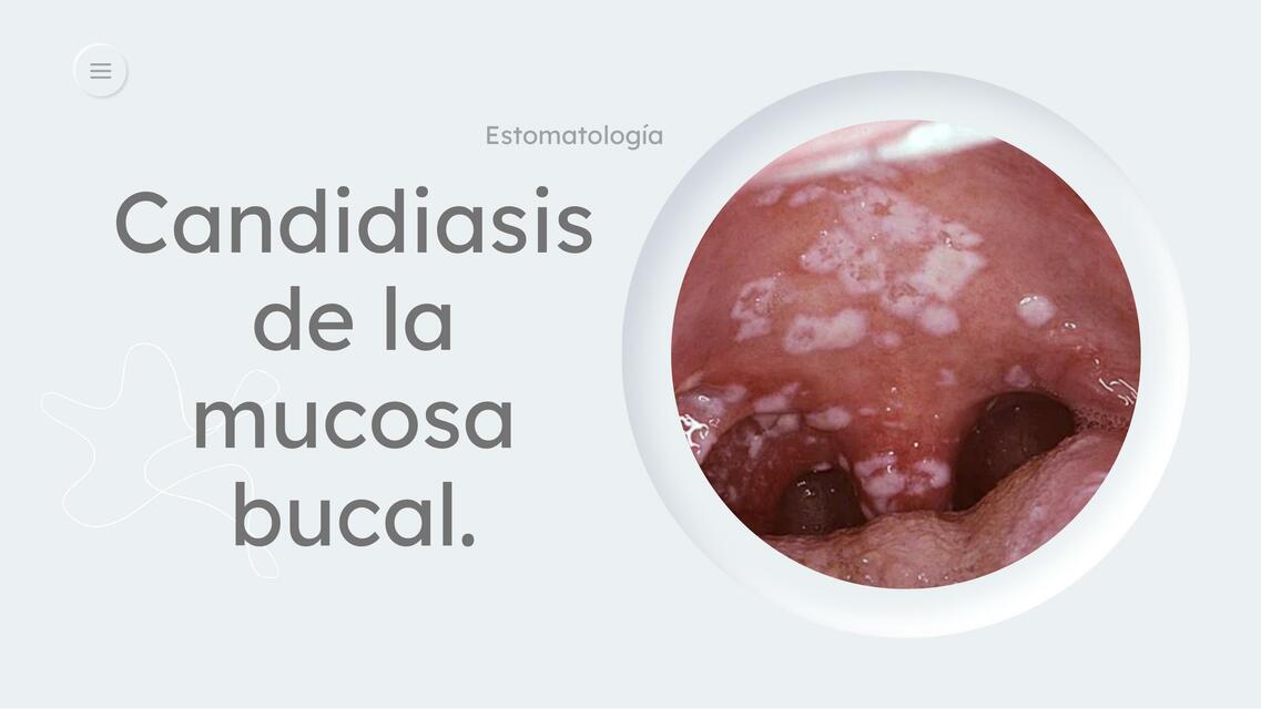 Candidiasis de la mucosa bucal | Mar.Med | uDocz