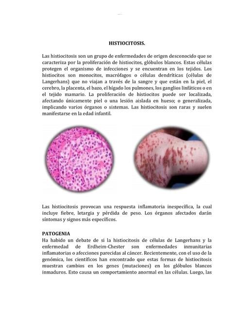 Histiocitosis Resumen | Docsity | uDocz