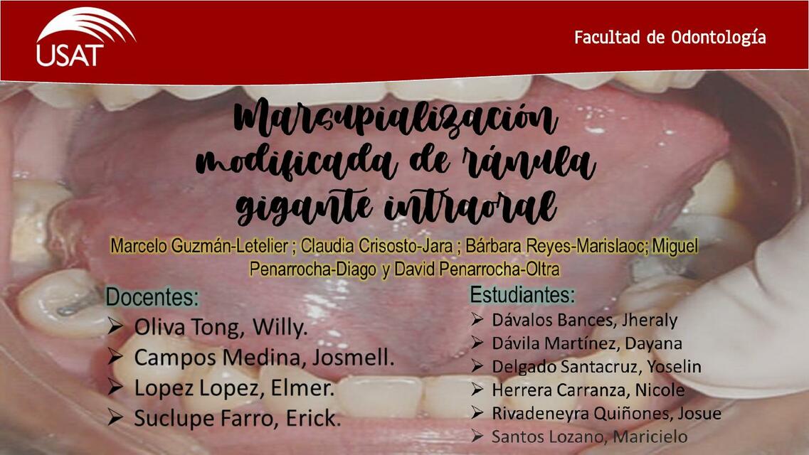 Marsupialización modificada de la ránula gigante intraoral | Nicole ...