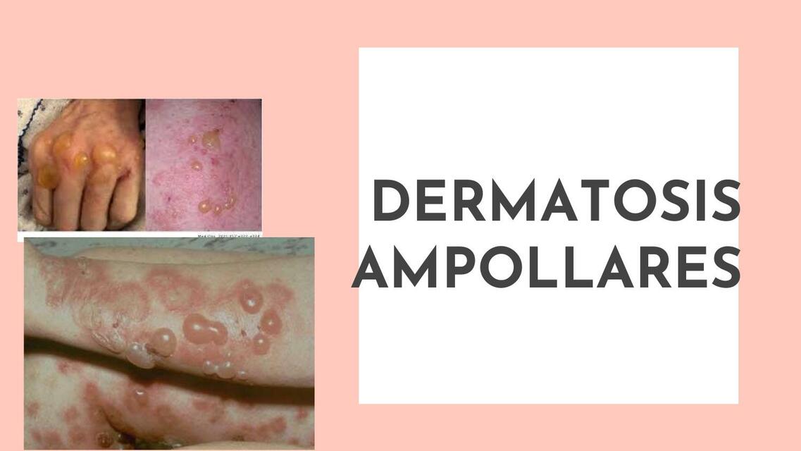 Dermatosis ampollares | CAROLINA | uDocz