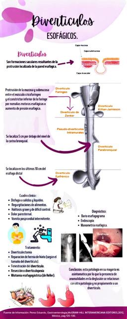Resúmenes de Divertículo esofágico | Descarga apuntes de Divertículo ...
