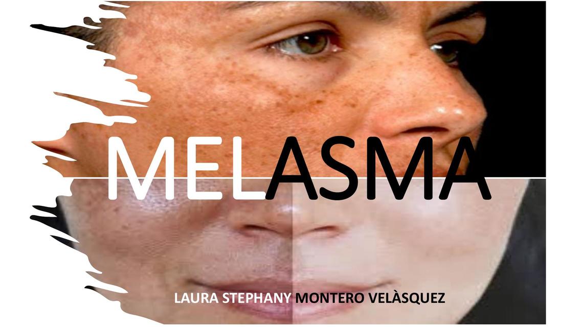 Melasma | Laura | uDocz